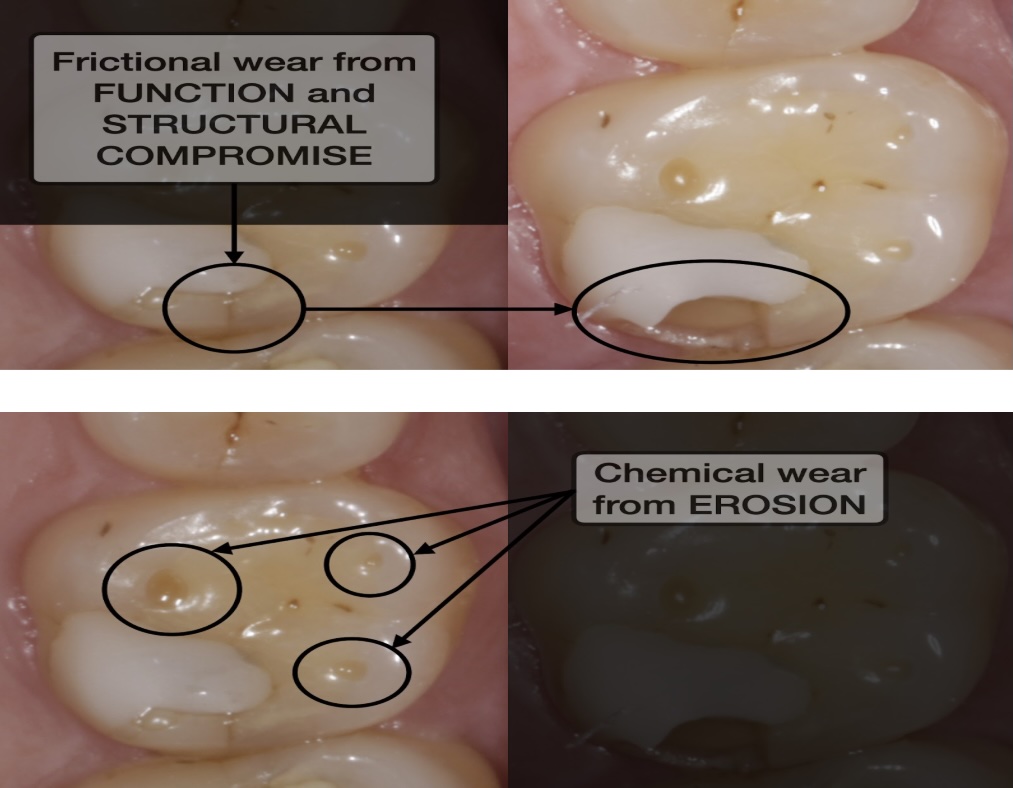Rethinking Tooth Wear: Why It’s Time to Change How We View Oral Health ...
